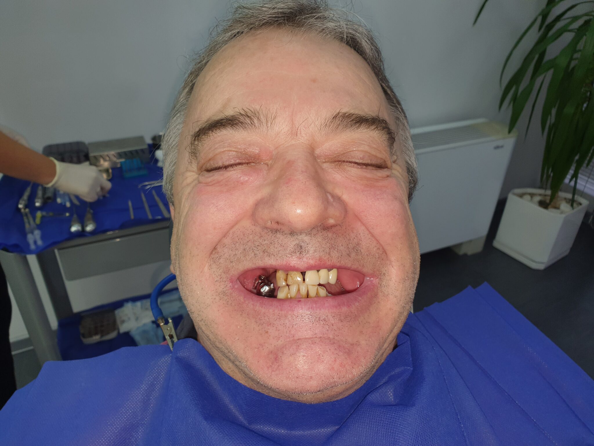 Greffe osseuse dentaire : Explications et risques - Sourire Dentaire