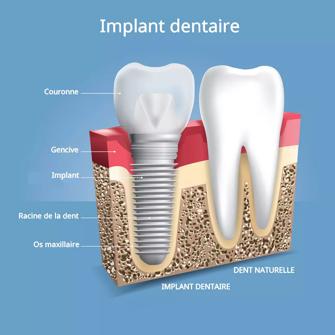 Retirer Un Implant Dentaire Prix